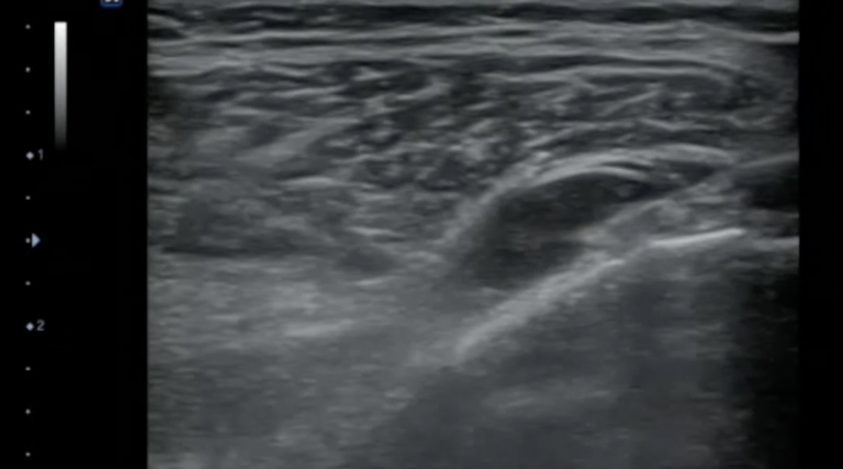 Infrapatella Branch of Sap Nerve - Cases - ULTRASOUNDCASES